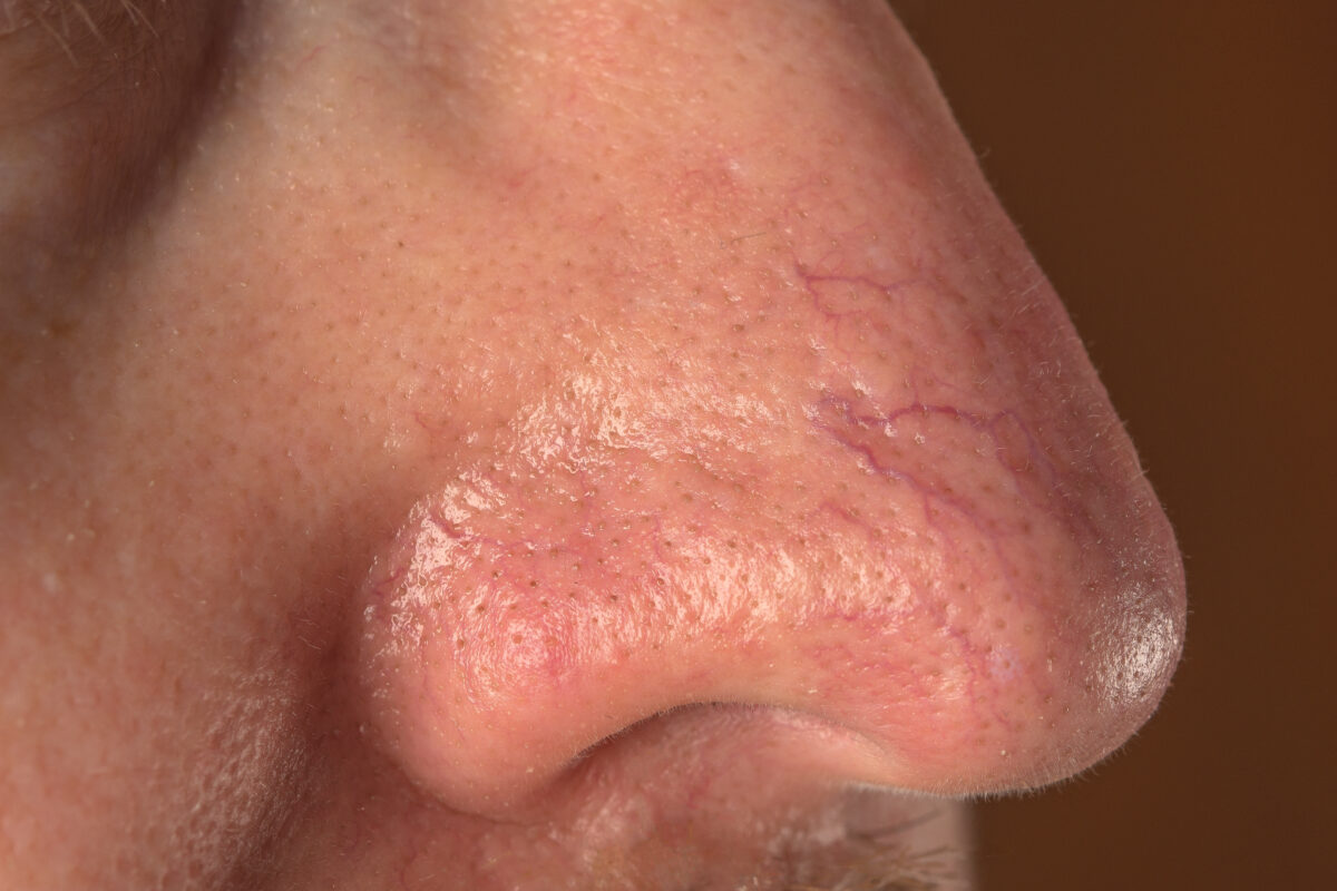Exercise-induced vasculitis - Dr. Breslavets Exercise-induced vasculitis - Dr. Breslavets